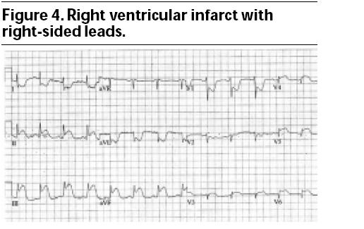 Mi Ecg Infarction Myocardial Waves Wave Evolution Inferior Inversion Time Ekg Acute Changes ...